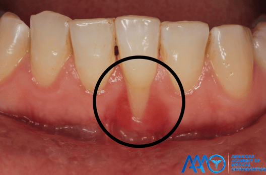 Receding Gums: Types, Symptoms, and Effective Treatments for Gum Recession