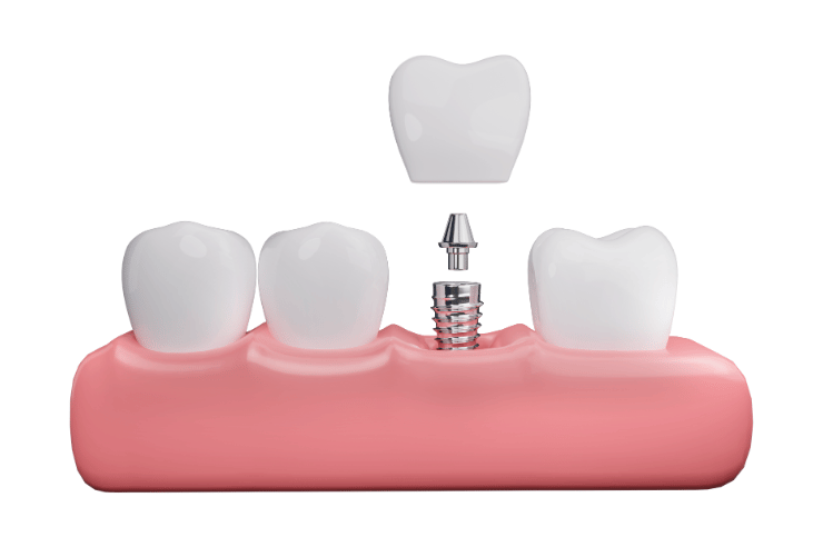 Dental Bridges | Tooth Bridges Treatment