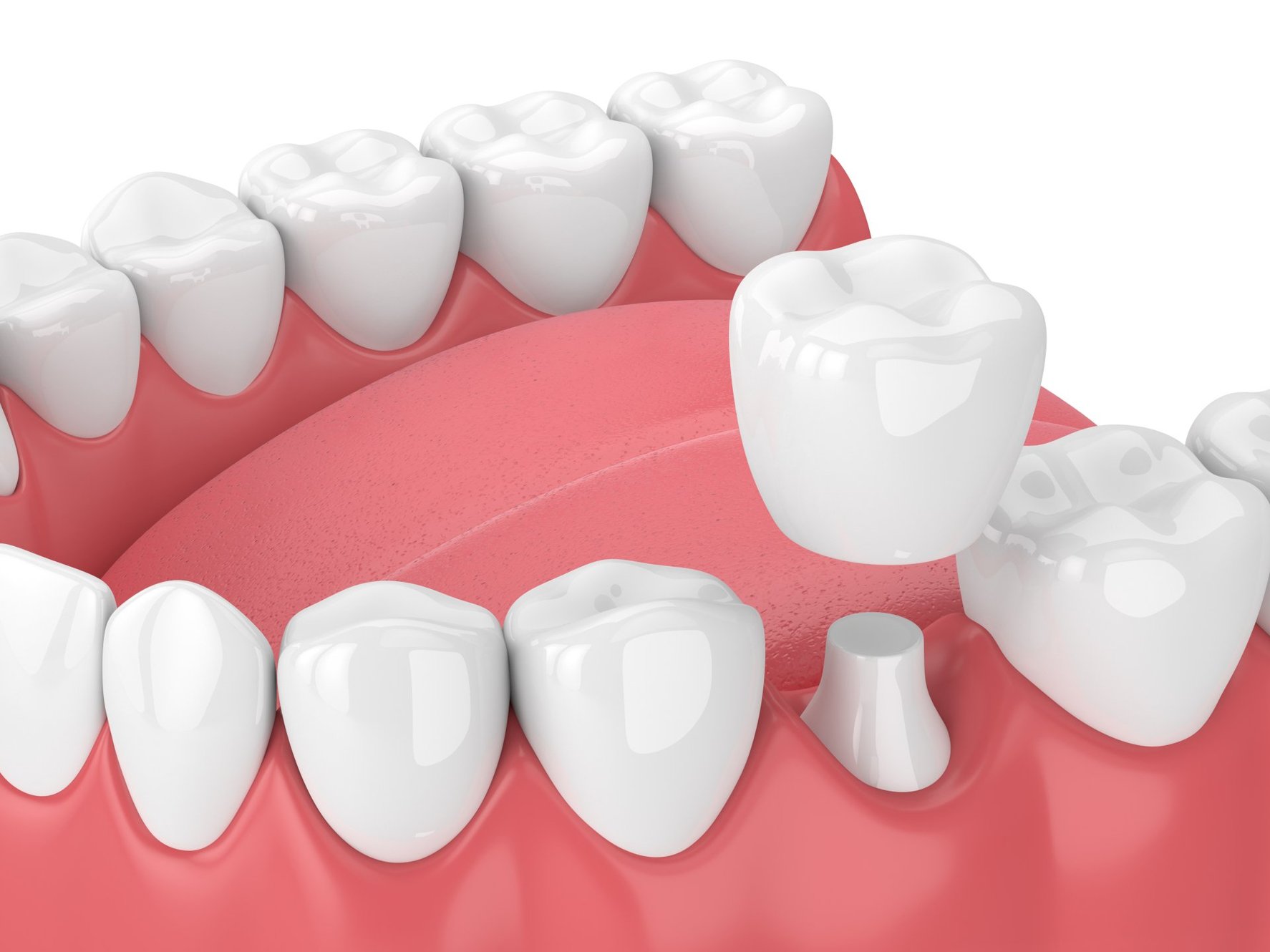 What Are Tooth Crowns? Uses, Materials, and When Dentists Recommend Them
