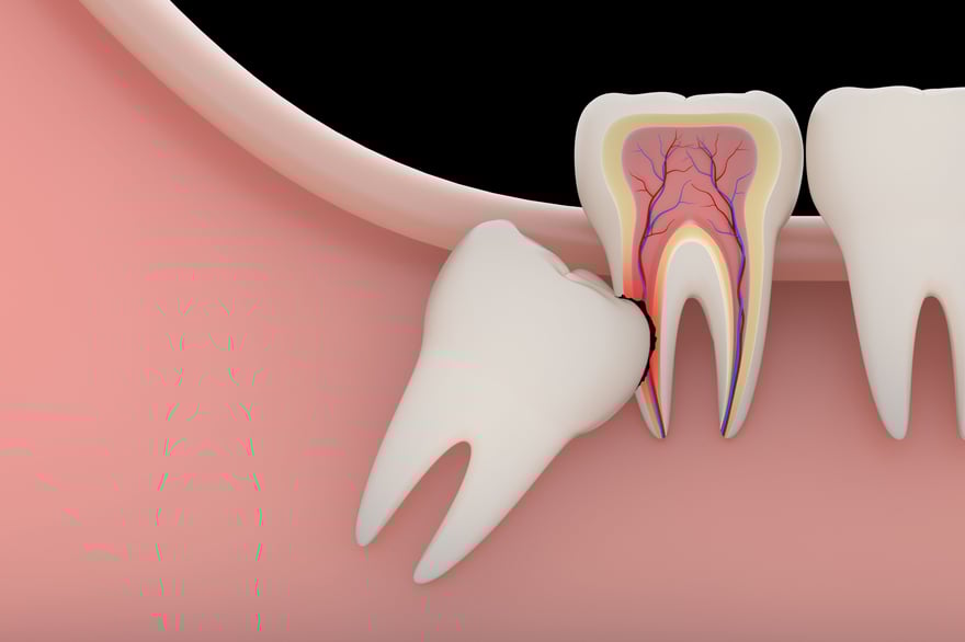 The Trouble with Impacted Teeth: Causes, Symptoms, and Treatment Options